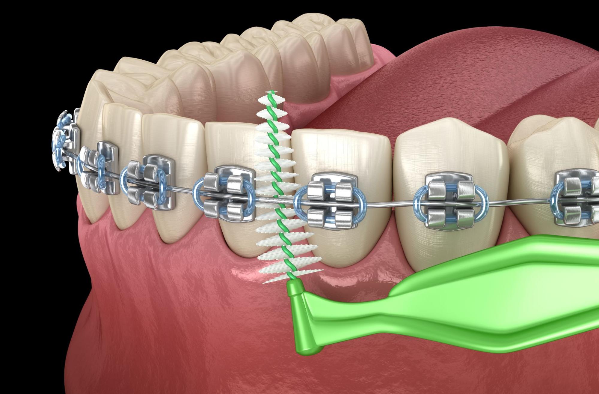 How to Brush Your Teeth With Braces? | Central Orthodontics