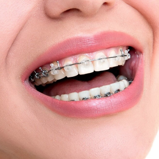 Different Types of Braces for Teeth | Teeth Straightening Treatments ...